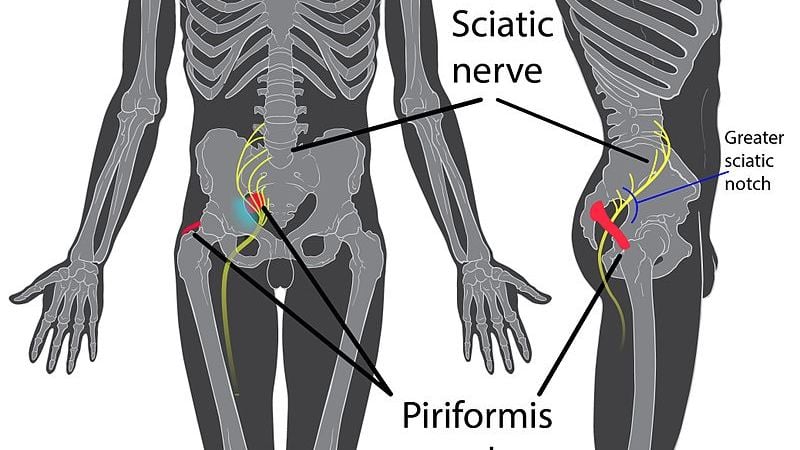 Nervo sciatico infiammato, cosa fare - Obiettivo Salute