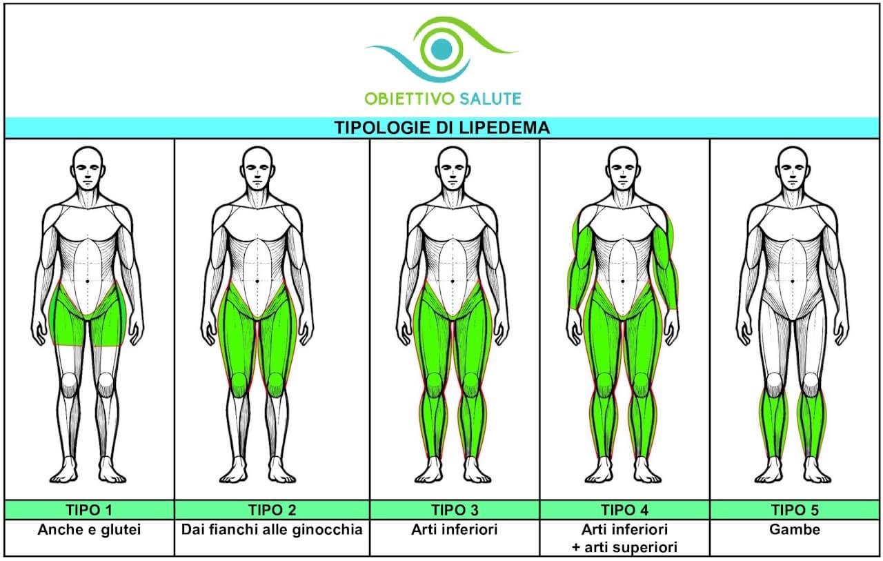 Lipedema | Cause, sintomi, diagnosi e trattamento