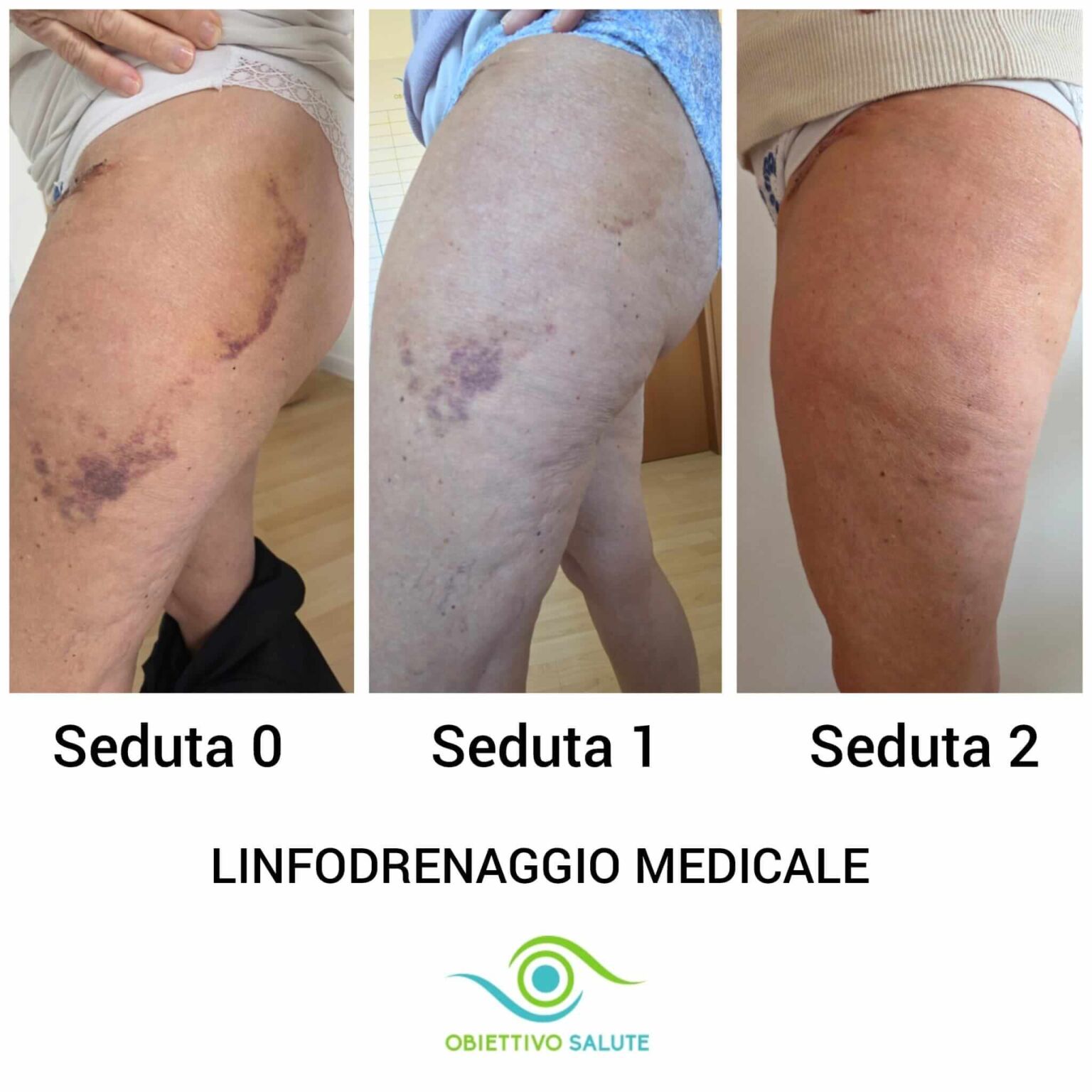 Edema post operatorio - Obiettivo Salute Chiasso